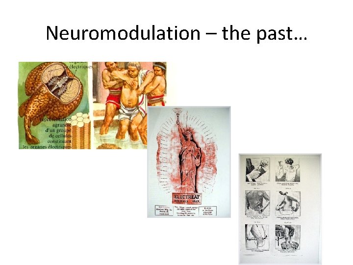 Neuromodulation what the future brings Alon Y Mogilner