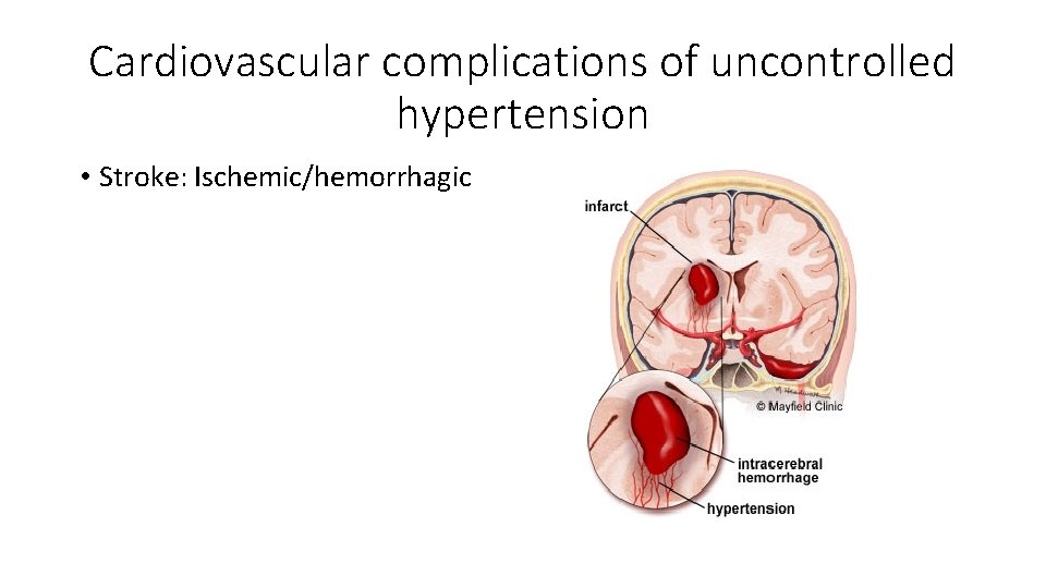 Blood Pressure Hypertension Orthostatics Sina Raissi MD FACP