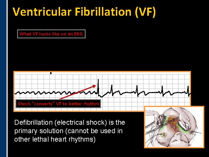 SUDDEN CARDIAC ARREST A Community Presentation on the