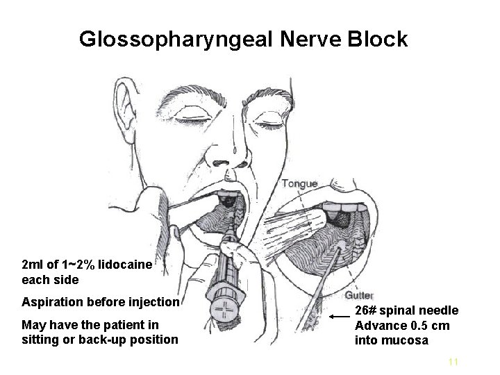 Difficult Airway Management in Anesthesia Part II Chan