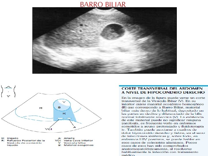 DR RAUL ROJAS R 2 URGENCIAS COLELITIASIS COLECISTITIS