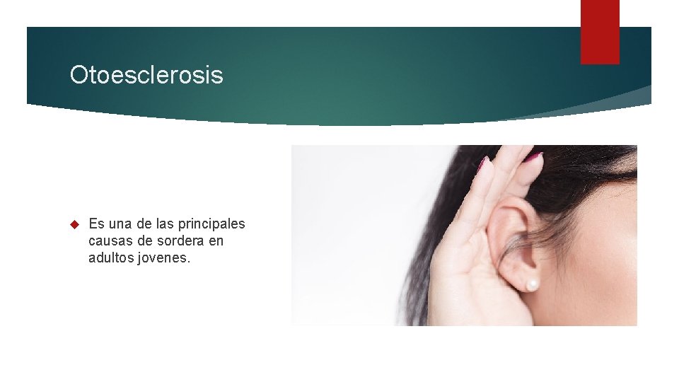 Otoesclerosis Otoesclerosis Es una de las principales causas