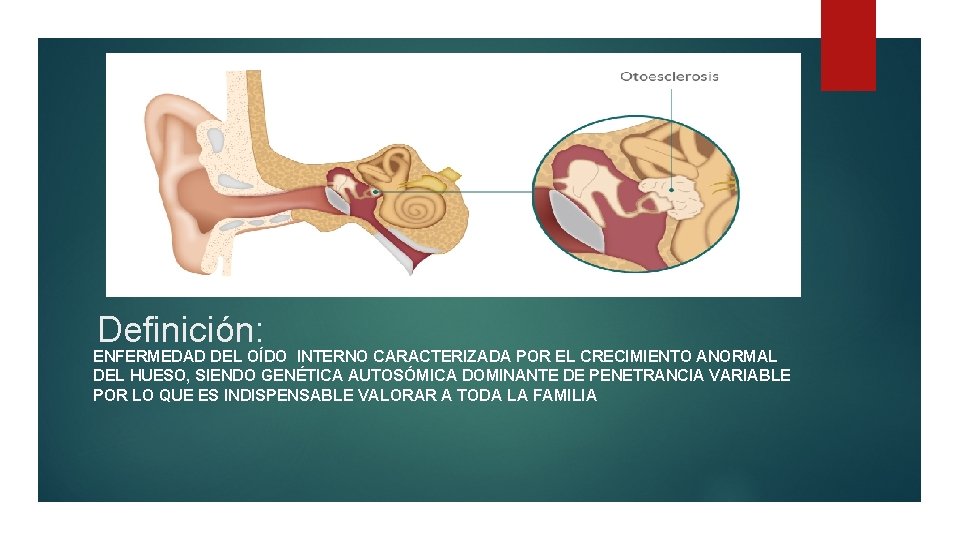 Otoesclerosis Otoesclerosis Es una de las principales causas
