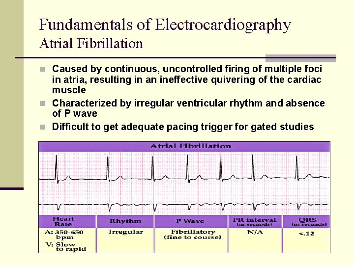 ECG Fundamentals of Electrocardiography The conduction system is
