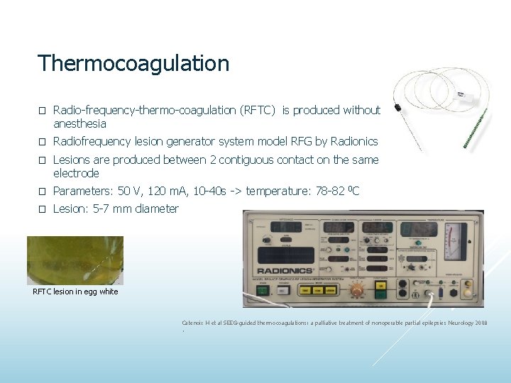 SEEGGUIDED RADIOFREQUENCY THERMOCOAGULATION IN EPILEPSY Ciurea Jean ...