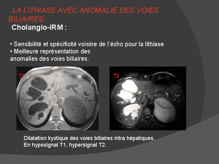 IMAGERIE DE LA LITHIASE BILIAIRE PLAN IIntroduction II