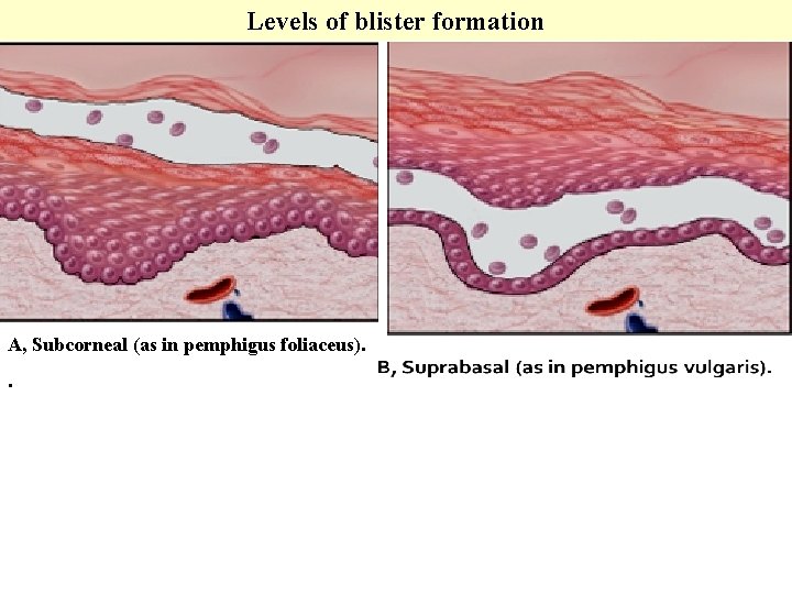 Immunoblistering Skin Diseases Dr Ahmed Abdulhussein ALHuchami 1