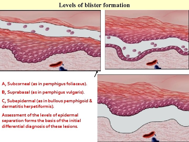 Immunoblistering Skin Diseases Dr Ahmed Abdulhussein ALHuchami 1