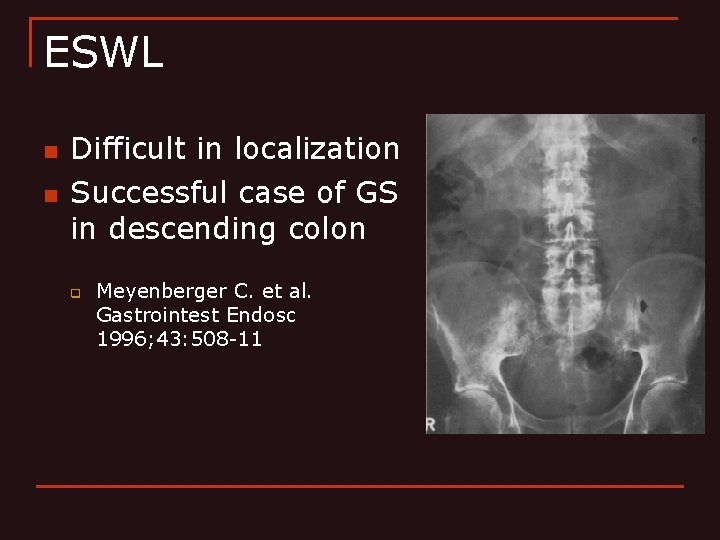 Management of Gallstone Ileus Joint Hospital Surgical Grand