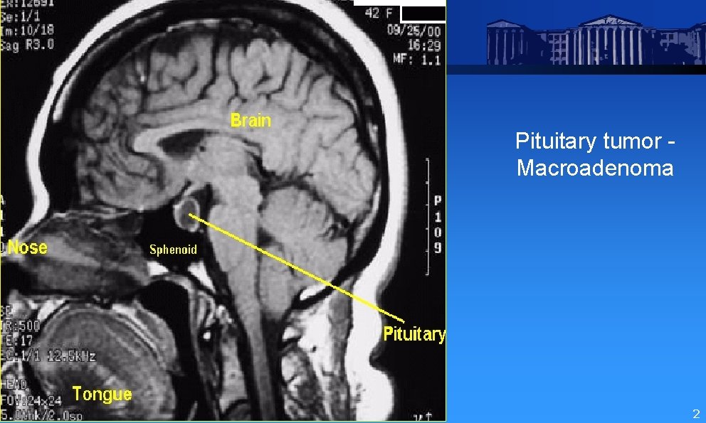 Pituitary Tumors SungWoon Kim MD Division of Endocrinology