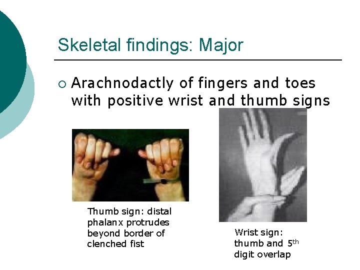 Marfans Syndrome Bradley K Harrison MD How do