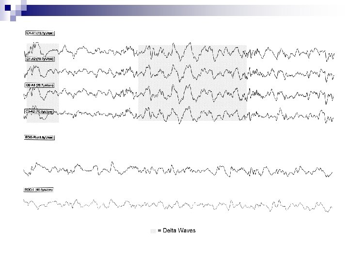 Interpretation of Polysomnography n Presented By Dr Mohammad
