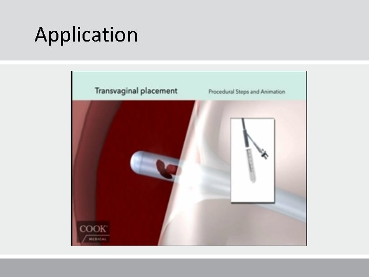 The simple solution for postpartum hemorrhage POSTPARTUM HAEMORRHAGE