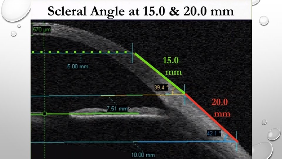 DW SCLERAL LENS DESIGN USING WAVE AND OCT