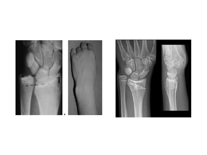 Common pediatric Fractures and Trauma DR Khalid A