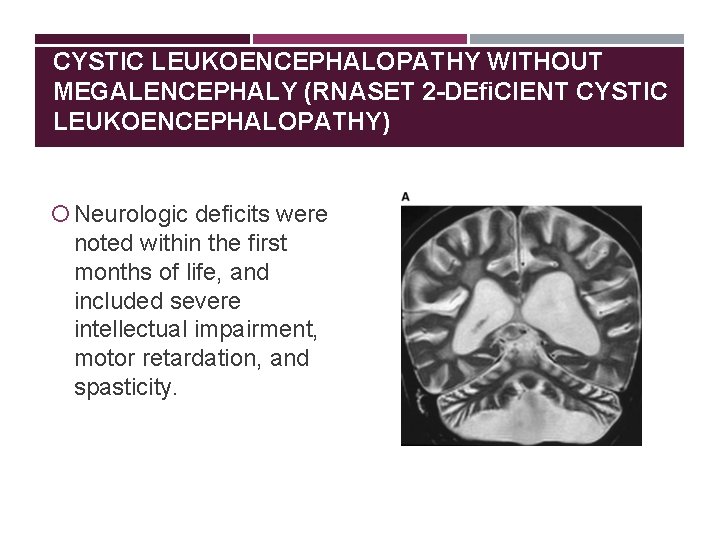 LEUKOENCEPHALOPATHIES ASSOCIATED WITH CALCIFICATIONS Mahvelati F MD Child