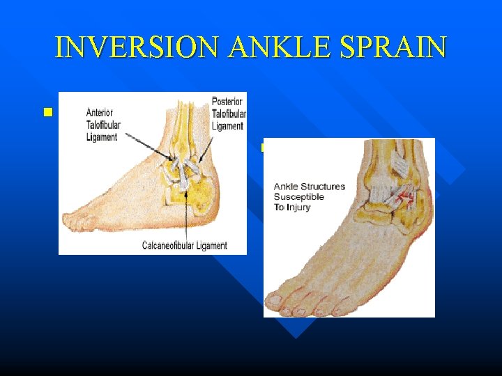Injuries to the Lower Leg Foot and Ankle
