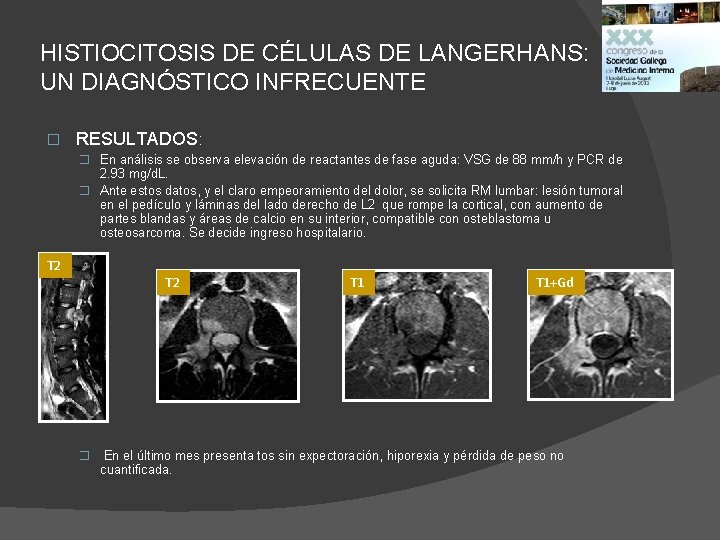 HISTIOCITOSIS DE CLULAS DE LANGERHANS UN DIAGNSTICO INFRECUENTE