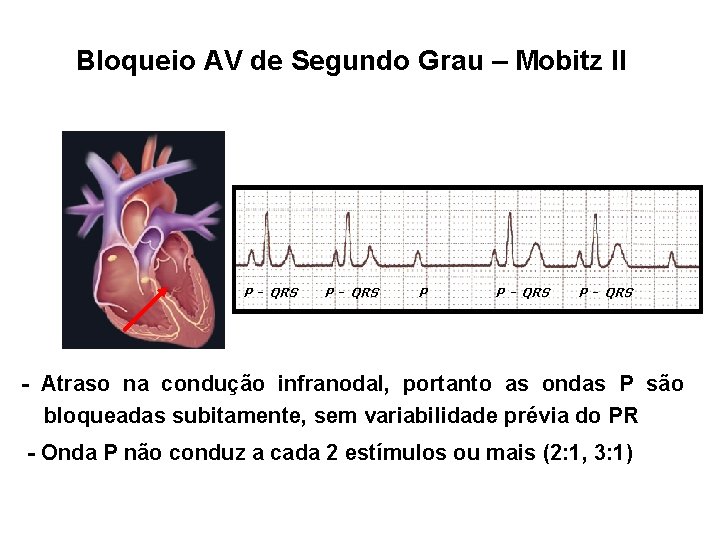 Eletrocardiograma II Calcule a frequncia cardaca do ECG