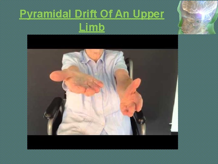 UPPER MOTOR NEURON HEMIPLEGIAPARAPLEGIA DR NASIR FAROOQ BUTT