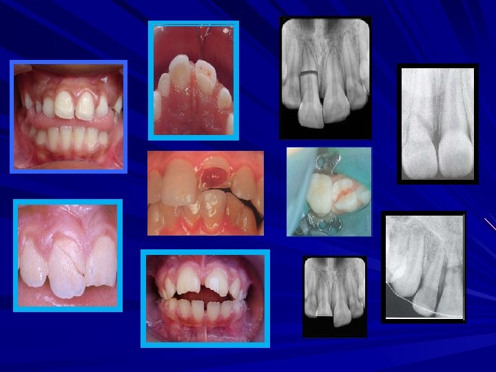ODONTOPEDIATRA TEMA V LESIONES TRAUMTICAS EN DIENTES TEMPORALES