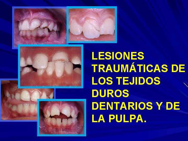 ODONTOPEDIATRA TEMA V LESIONES TRAUMTICAS EN DIENTES TEMPORALES