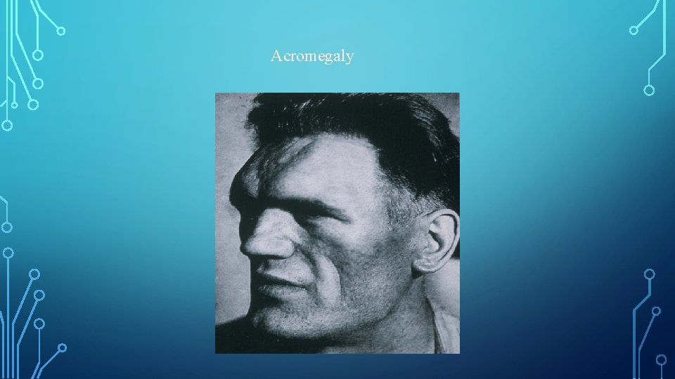 ACROMEGALY CONNECTIONS WITH MIND BODY INDIVIDUAL FAMILY AND