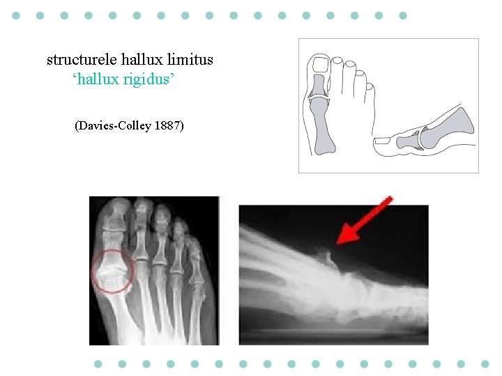 Posterior impingement van de enkel de rol van