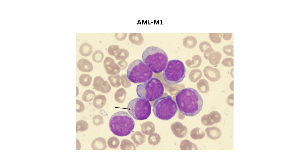 Acute Leukemias Accumulation of blasts in the marrow