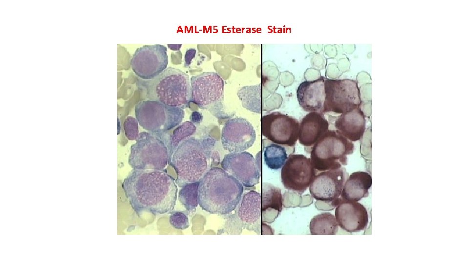 Acute Leukemias Accumulation of blasts in the marrow