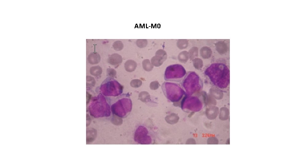 Acute Leukemias Accumulation of blasts in the marrow