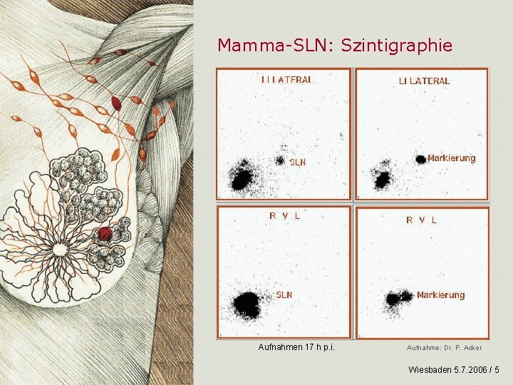 SLN WchterLymphknoten beim Mammakarzinom Der sentinel lymph node