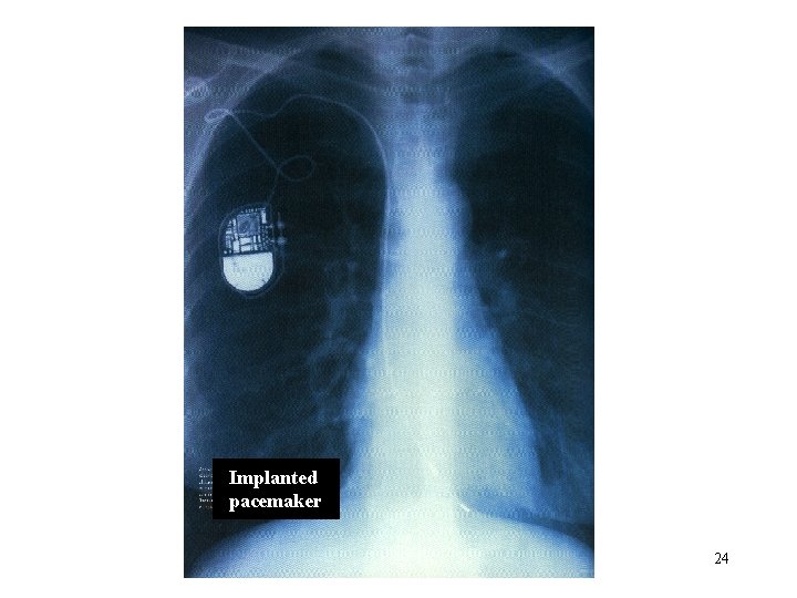 BMT 414 Pacemakers Dr Ali Saad Biomedical Engineering