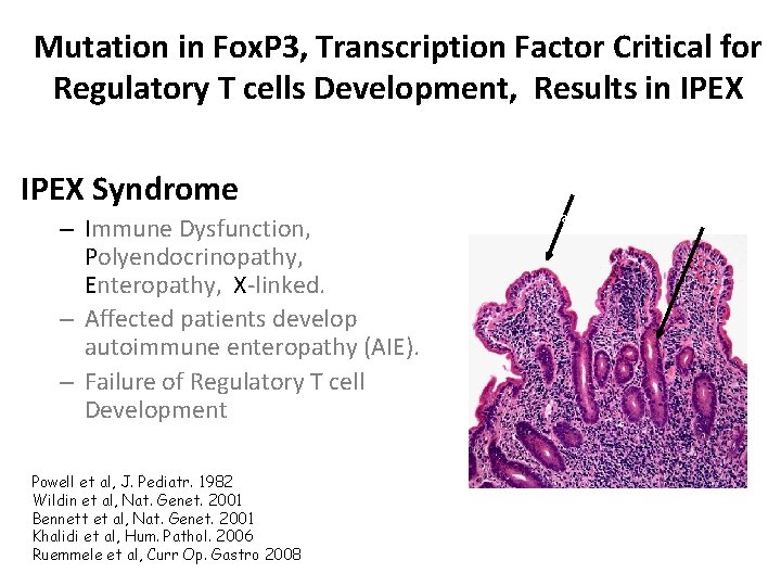 Genetic Mutations in Young Children with IBD Insights