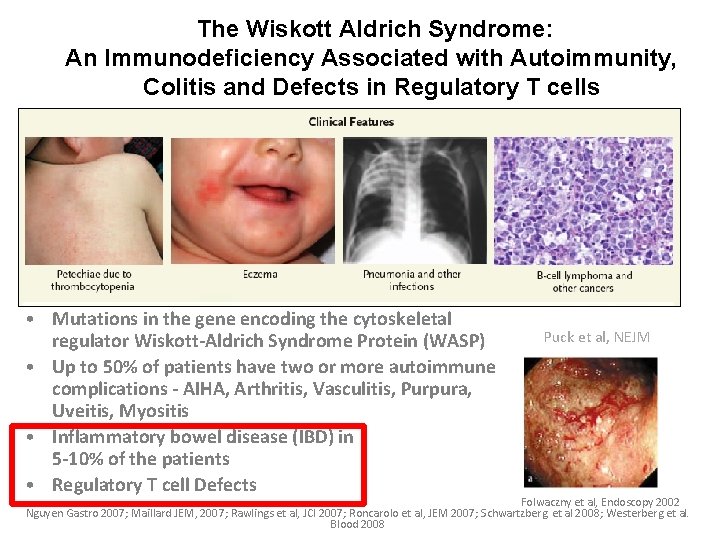 Genetic Mutations in Young Children with IBD Insights