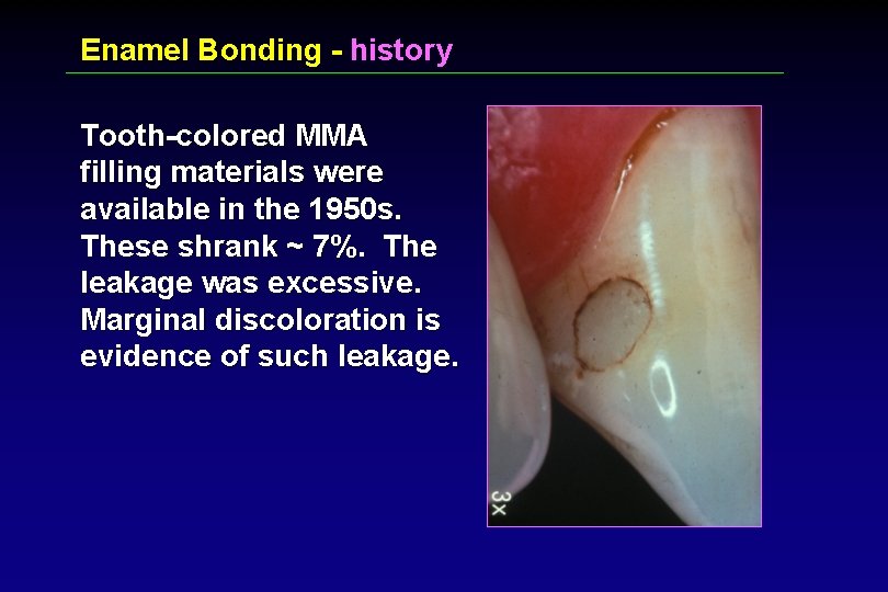 Bonding to Enamel Enamel Bonding history Toothcolored MMA