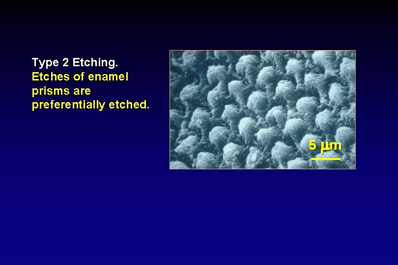 Bonding to Enamel Enamel Bonding history Toothcolored MMA