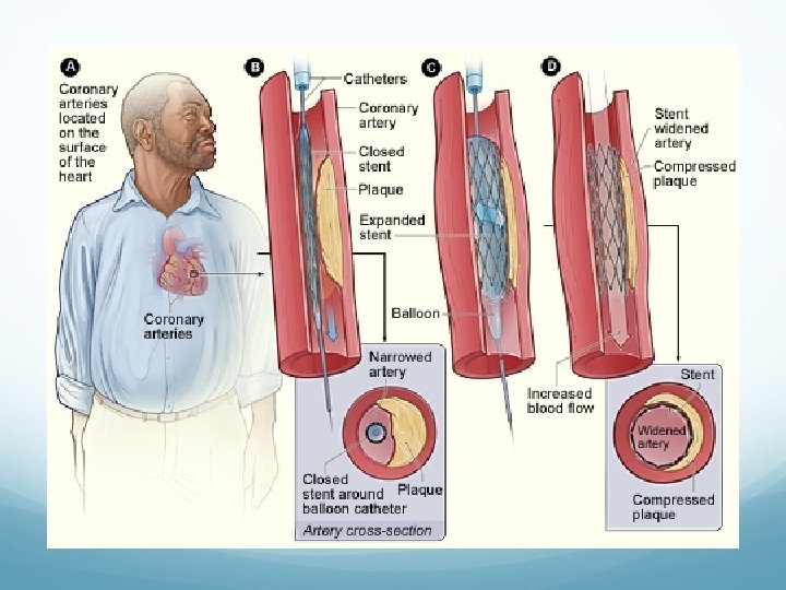Dissolvable Heart Stents Richard Melpignano Coronary Heart Disease