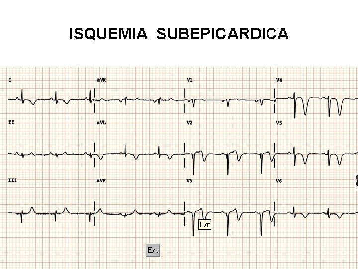 ISQUEMIA LESION Y NECROSIS CAMBIOS EKG ISQUEMIA ONDA
