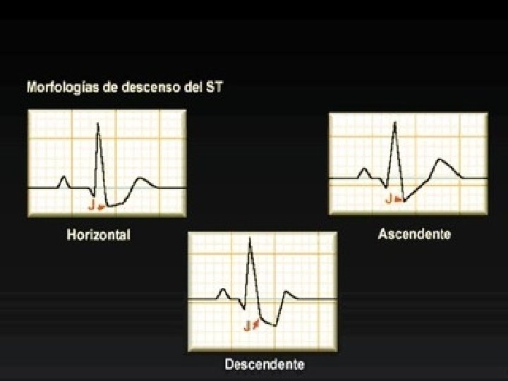 ISQUEMIA LESION Y NECROSIS CAMBIOS EKG ISQUEMIA ONDA