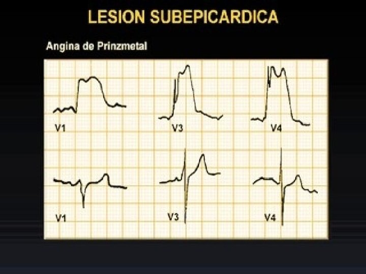 ISQUEMIA LESION Y NECROSIS CAMBIOS EKG ISQUEMIA ONDA