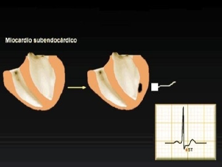 ISQUEMIA LESION Y NECROSIS CAMBIOS EKG ISQUEMIA ONDA
