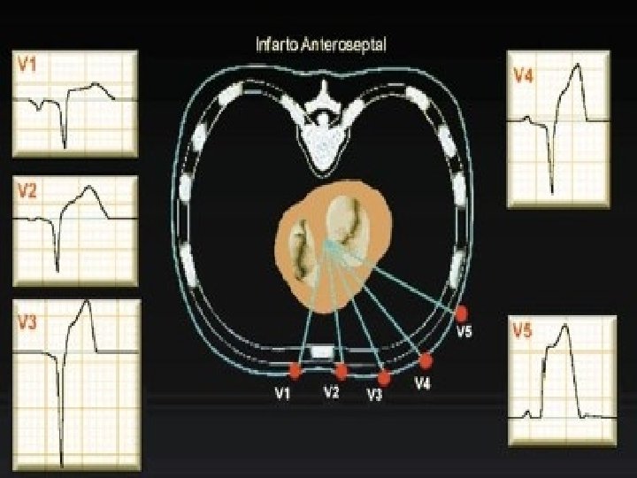 ISQUEMIA LESION Y NECROSIS CAMBIOS EKG ISQUEMIA ONDA