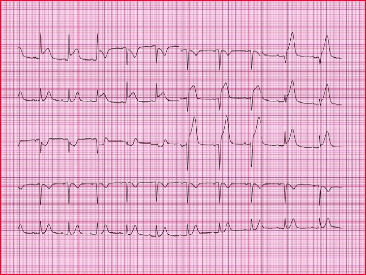 ISQUEMIA LESION Y NECROSIS CAMBIOS EKG ISQUEMIA ONDA