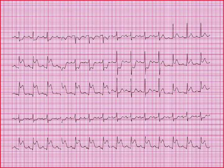 ISQUEMIA LESION Y NECROSIS CAMBIOS EKG ISQUEMIA ONDA