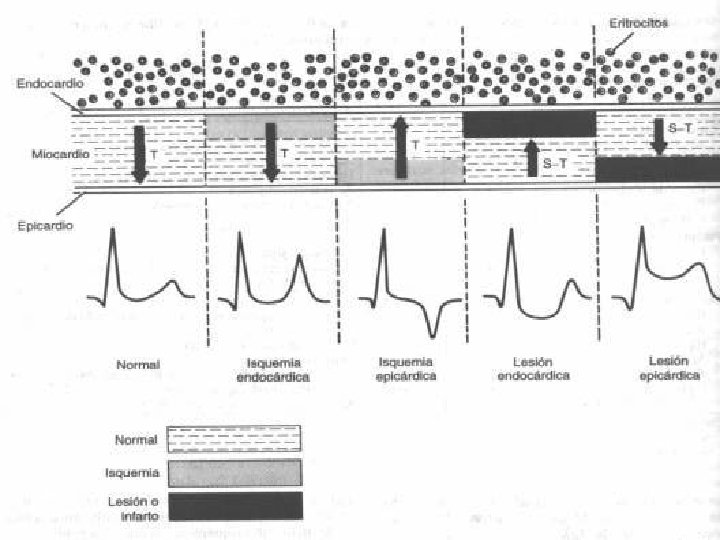 ISQUEMIA LESION Y NECROSIS CAMBIOS EKG ISQUEMIA ONDA