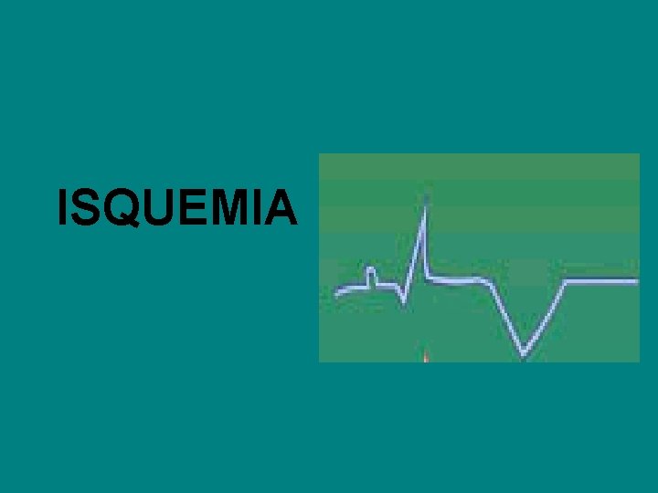 ISQUEMIA LESION Y NECROSIS CAMBIOS EKG ISQUEMIA ONDA