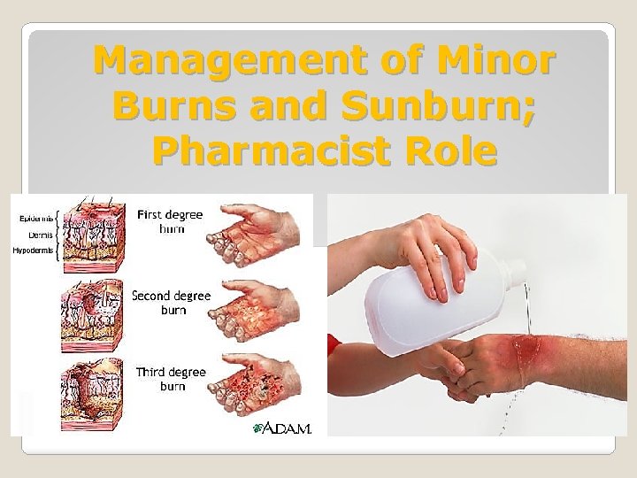Management of Minor Burns and Sunburn Pharmacist Role