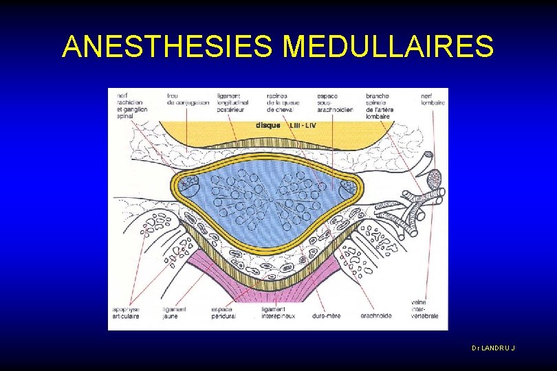 ANESTHESIE LOCOREGIONALE Dr LANDRU J Anesthsie slective dune