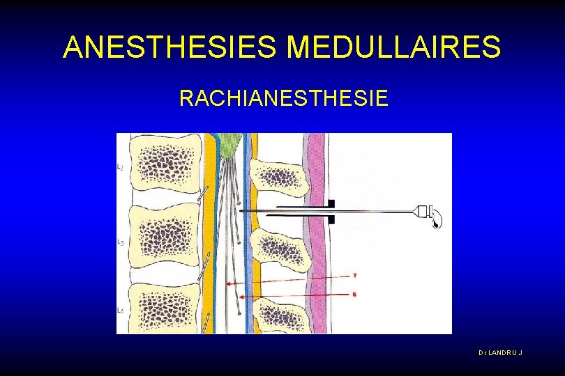 ANESTHESIE LOCOREGIONALE Dr LANDRU J Anesthsie slective dune